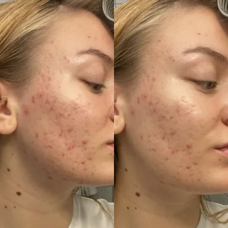 Cloud Mist – Ansiktsmist med hypoklorsyra. Aknebenägen, känslig hud ...