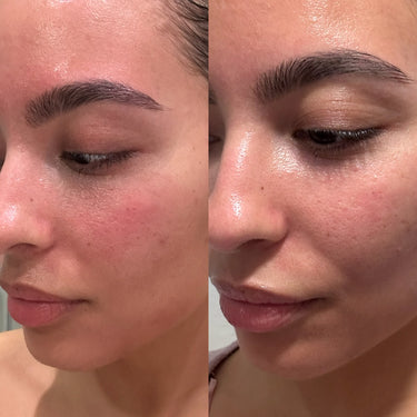 Cloud Mist – Ansiktsmist med hypoklorsyra. Aknebenägen, känslig hud ...