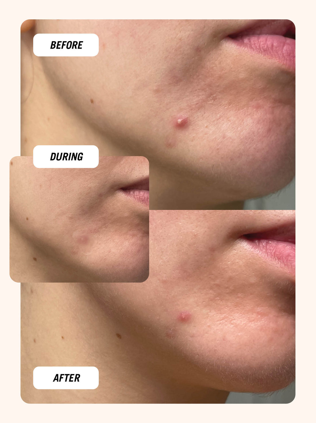 Cloud Pimple Patch from Vegan Hydrocolloid | For Acne-Prone Skin ...